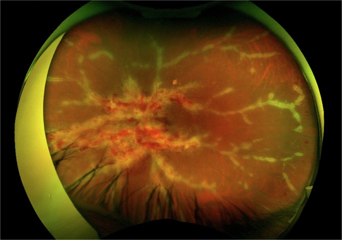Severe cytomegalovirus retinitis | Eye