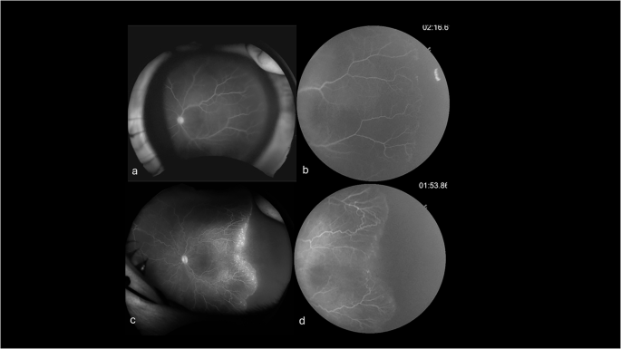 Differences between non-contact and contact fundus fluorescein ...
