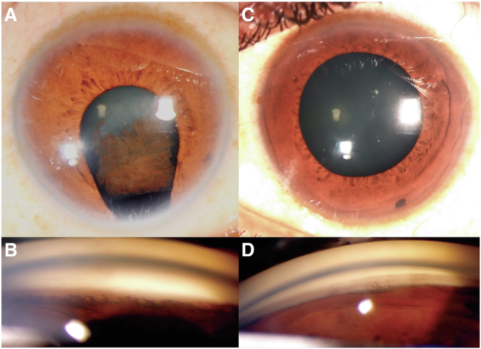 Epicapsular pigment stars: a marker for gonio-dysgenesis | Eye