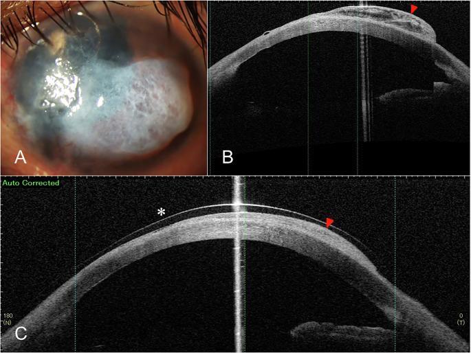 Ripasudil as a treatment for corneal bullae: a potential role in ...