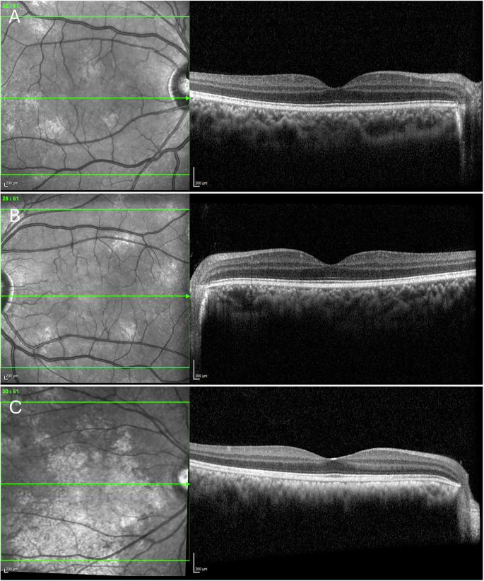 Choroidal abnormalities in neurofibromatosis type 1 | Eye