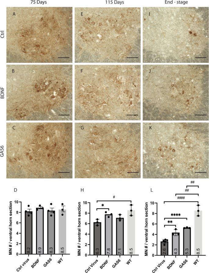 AAV-mediated BDNF and GAS6 muscle delivery delays disease onset in ...