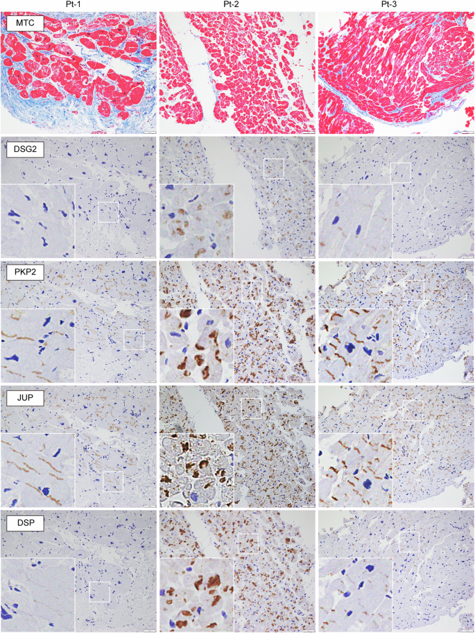 Four cardiomyopathy patients with a heterozygous DSG2 p.Arg119Ter ...