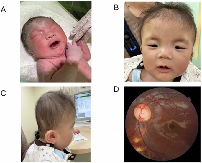 A case of Baraitser–Winter cerebrofrontofacial syndrome diagnosed by whole-exome sequencing ...