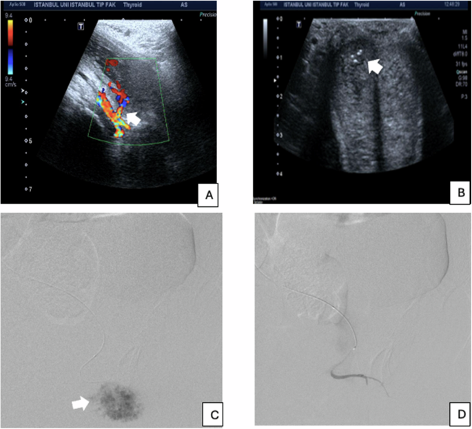 The role of the urologist in managing high flow priapism ...