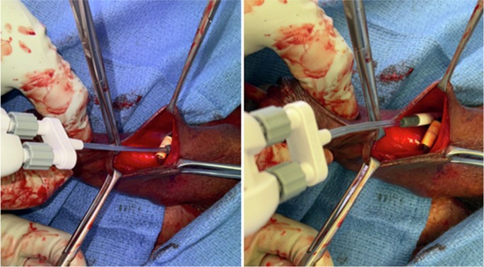 Zero infection protocol in inflatable penile prosthesis surgery: a ...