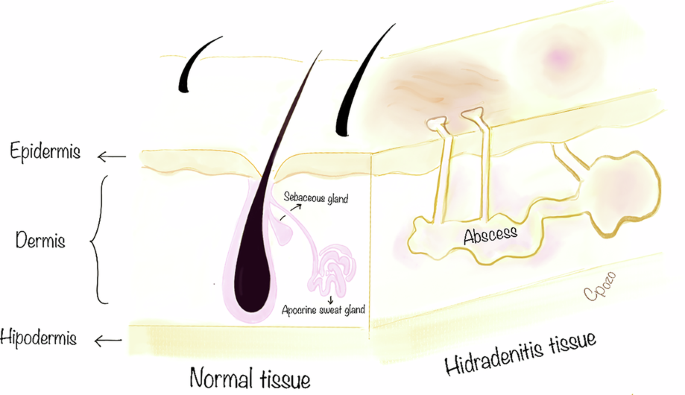 Management of penoscrotal hidradenitis: a narrative review ...