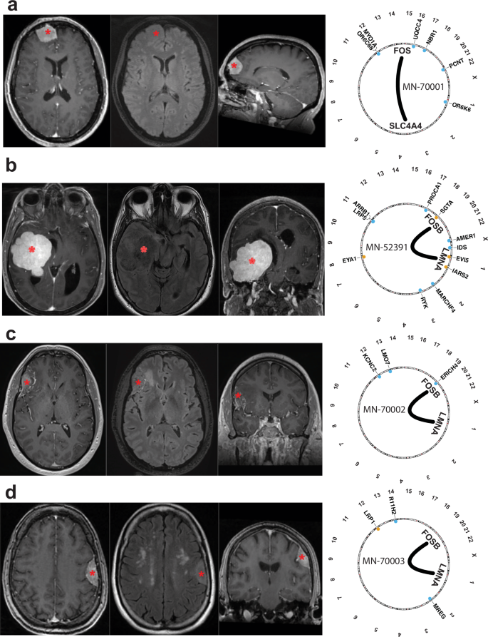 Subgroup of meningiomas involving FOS and FOSB gene fusions | Nature ...