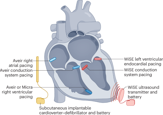 Leadless and extravascular cardiac resynchronization therapy: the ...