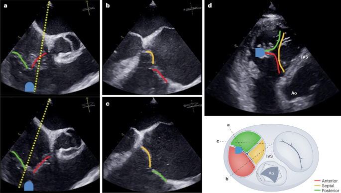 Tricuspid valve disease: updates on diagnostic imaging and intervention ...