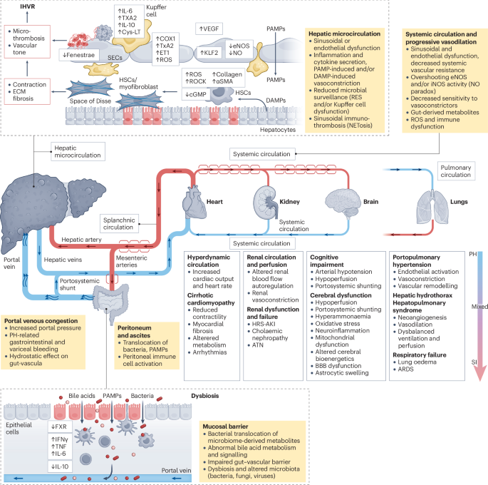 Interaction of inflammation and portal hypertension in cirrhosis ...