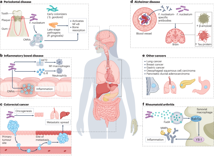 Fusobacterium nucleatum: ecology, pathogenesis and clinical ...