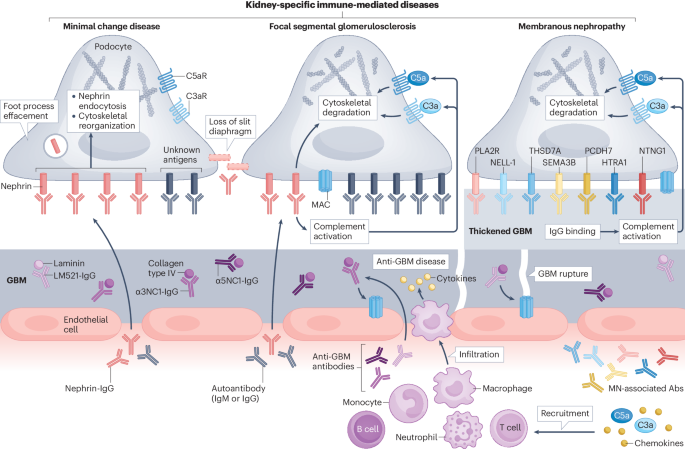 Anti-nephrin autoantibodies: a paradigm shift in podocytopathies ...