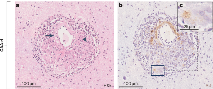 Amyloid-related imaging abnormalities: manifestations, metrics and ...