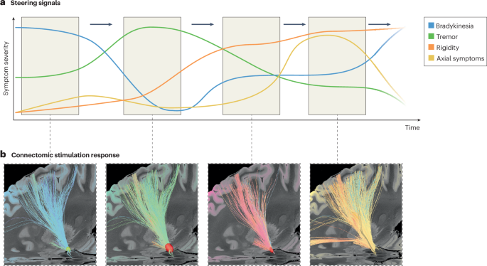 From adaptive deep brain stimulation to adaptive circuit targeting | Nature Reviews Neurology
