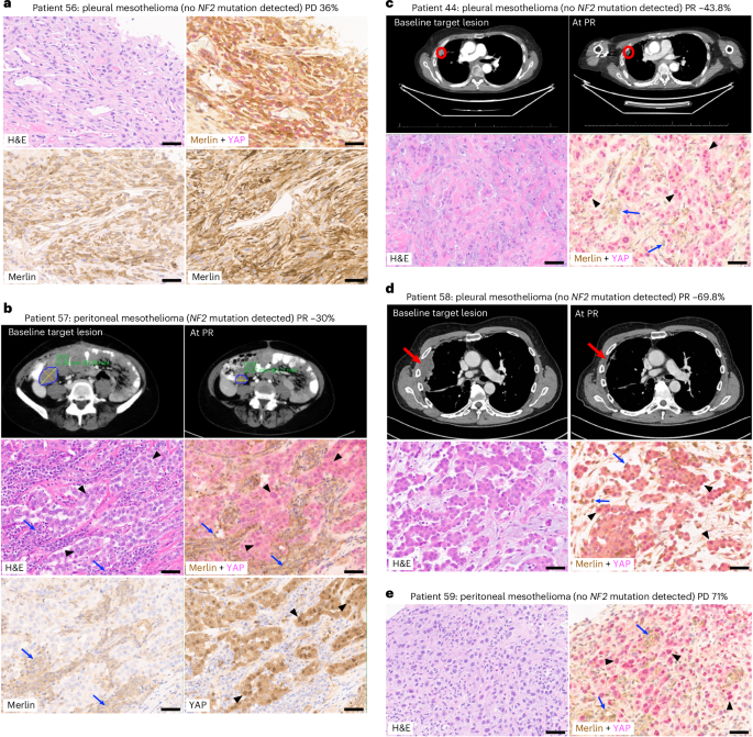 YAP/TEAD inhibitor VT3989 in solid tumors: a phase 1/2 trial | Nature ...