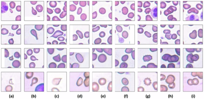 1 Million Segmented Red Blood Cells With 240 K Classified in 9 Shapes ...