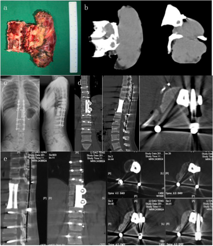 Sagittal en bloc resection of primary tumors in the thoracic and lumbar ...