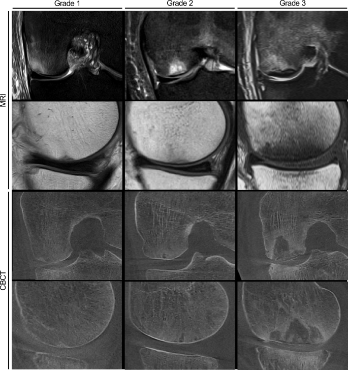 Advantages of cone beam computed tomography for evaluation of subchondral insufficiency ...