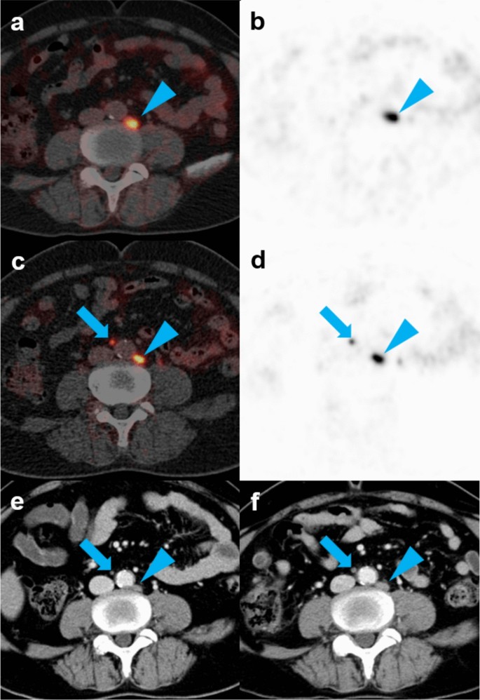 Comparison of digital and analog [68Ga]Ga-PSMA-11 PET/CT for detecting ...