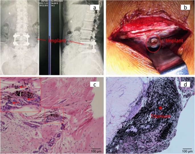 Wear and corrosion of titanium alloy spinal implants in vivo ...
