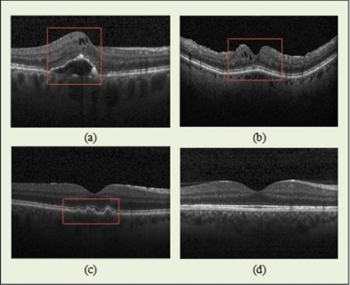 A novel approach for automatic classification of macular degeneration ...