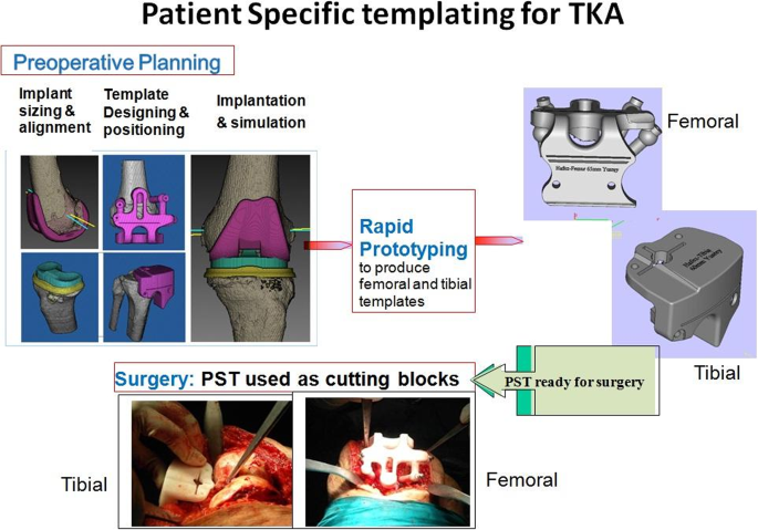 Laboratory validation of patient-specific templating for total knee ...