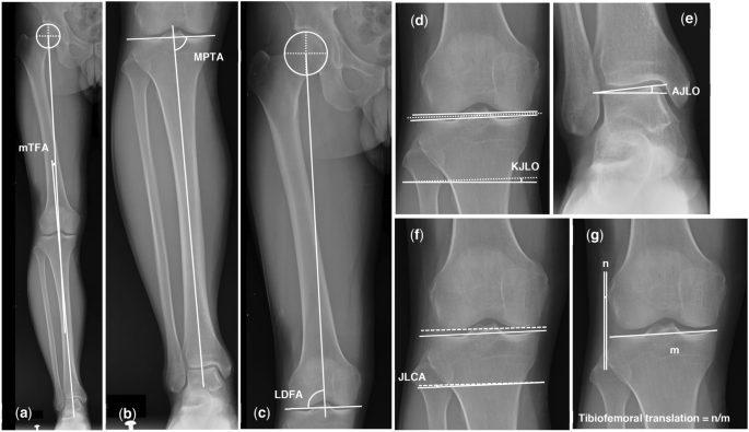 Correction to at least neutral alignment during high tibial osteotomy ...