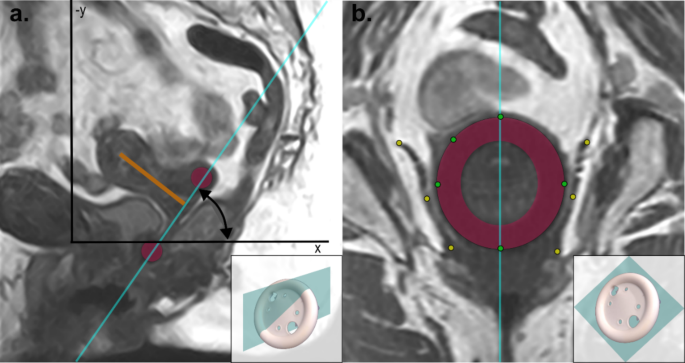 Analysing the support mechanisms of the vaginal ring pessary on supine ...