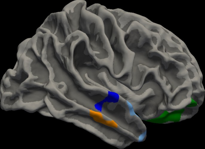 Structural MRI study of Pareidolia and Visual Hallucinations in Drug ...