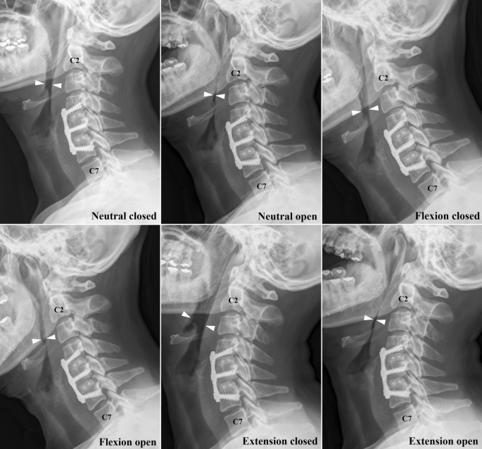 Neck extension with closed mouth position provides optimal airway ...