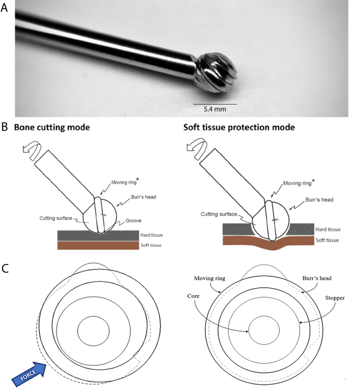 Evaluation of a novel high speed burr tip for safe and efficient bone ...