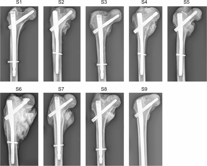 Femoral strength after cephalomedullary nail removal can be predicted preoperatively using CT ...