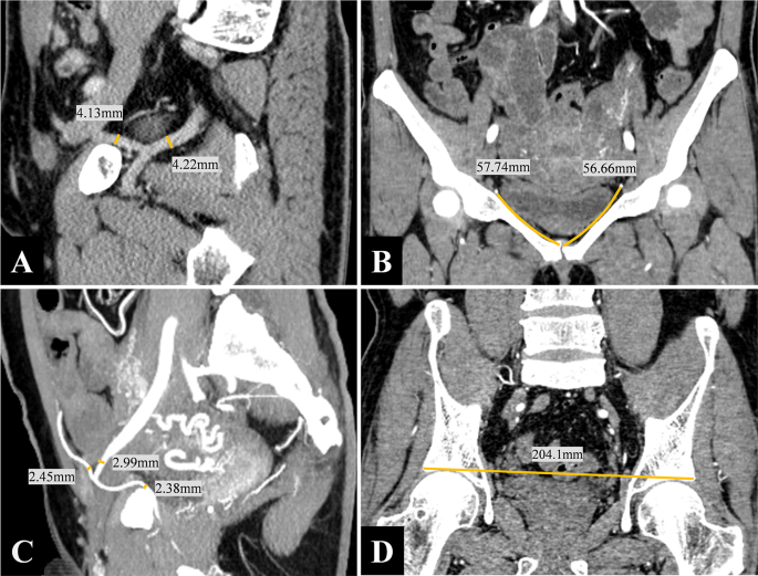 CT imaging findings of corona mortis and a new method for venous typing ...