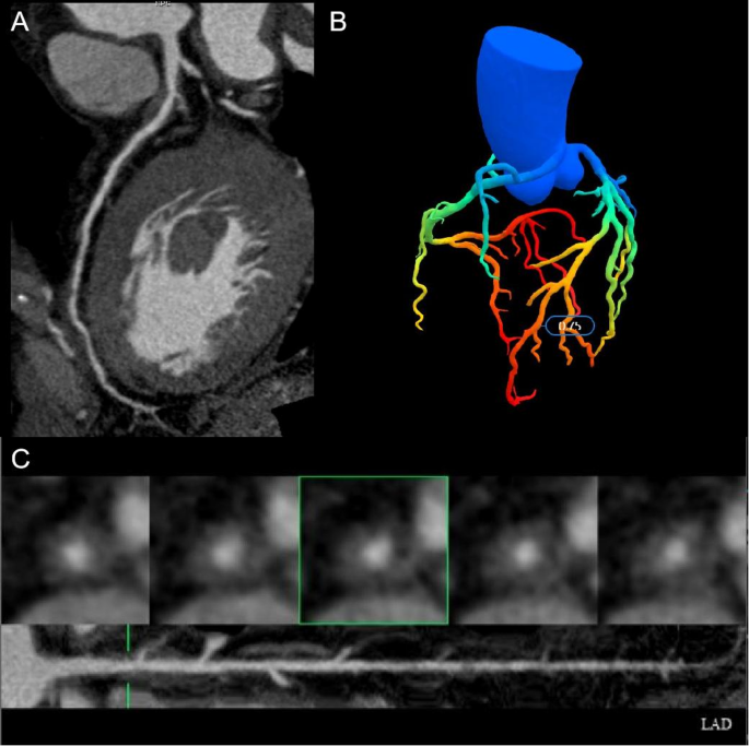 Computed tomography derived FFR and plaque features in prognosis of ...