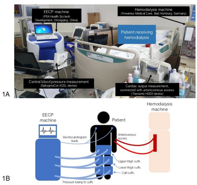 Enhanced external counter pulsation as a novel therapy to maintain ...