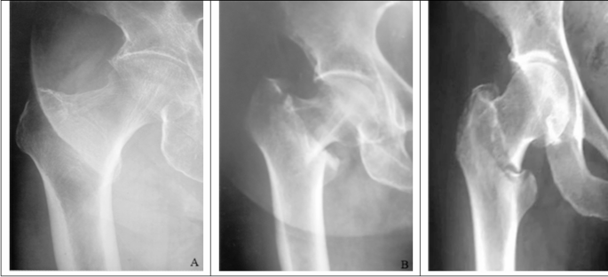 Finite element analysis of implant selection and screw positioning in ...