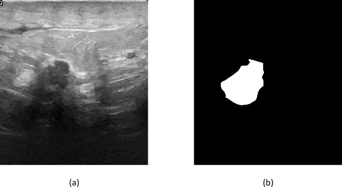 Multimodal fusion of ultrasound images using HXM net for breast cancer ...