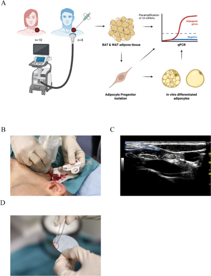 An ultrasound-guided biopsy technique for obtaining supraclavicular ...