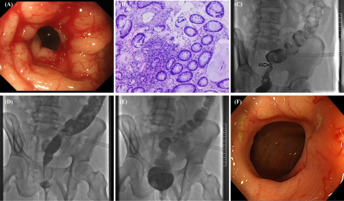 A comparative study of small and large balloon dilation for the ...