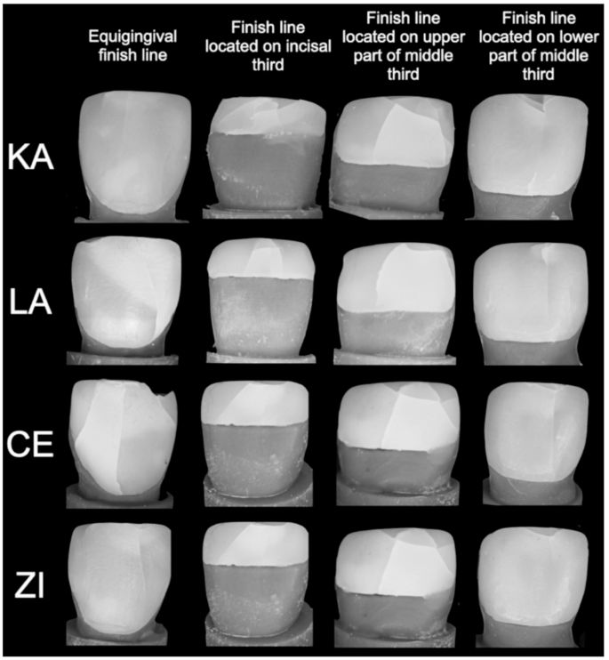 Fracture resistance of highly translucent zirconia laminate veneers ...