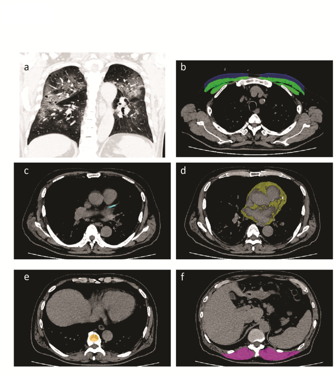 CT-based phenotyping of COVID-19: cluster analysis of pulmonary and ...