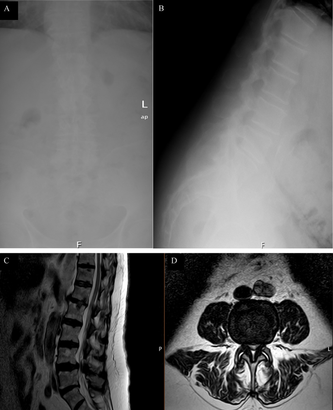 Radiographic and clinical outcomes at 12 months following full ...