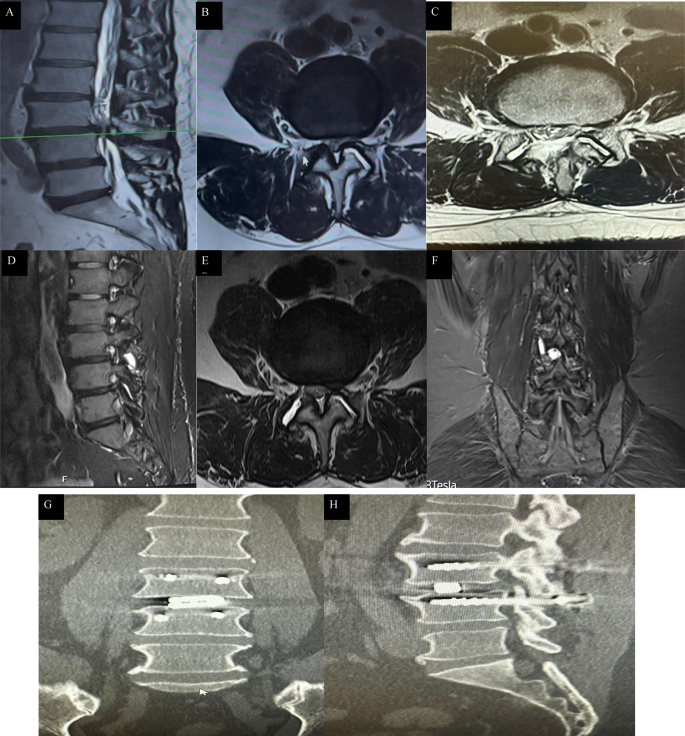 Radiographic and clinical outcomes at 12 months following full ...