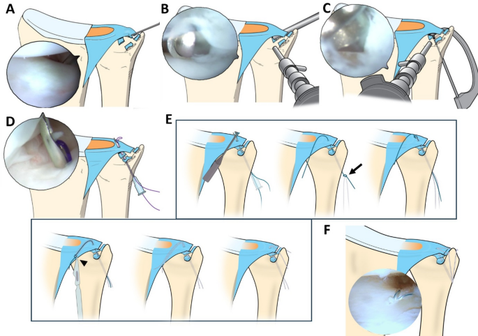 Arthroscopy assisted single bone tunnel two stranded en Masse repair ...
