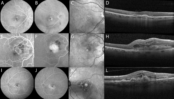 Comparison of optical coherence tomography vs. fluorescein angiography ...