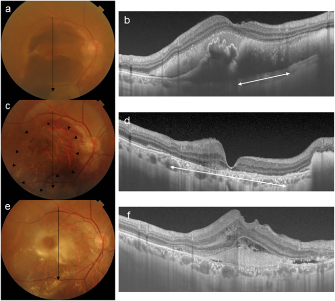 Assessment of retinal pigment epithelium tears in eyes with submacular ...