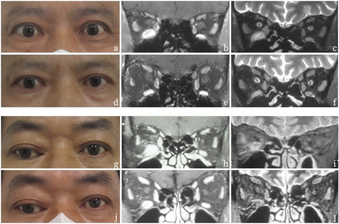 A curative effect evaluation of intensity-modulated radiation therapy ...