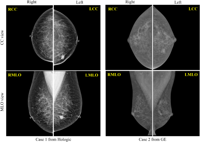 Leveraging paired mammogram views with deep learning for comprehensive breast cancer detection ...