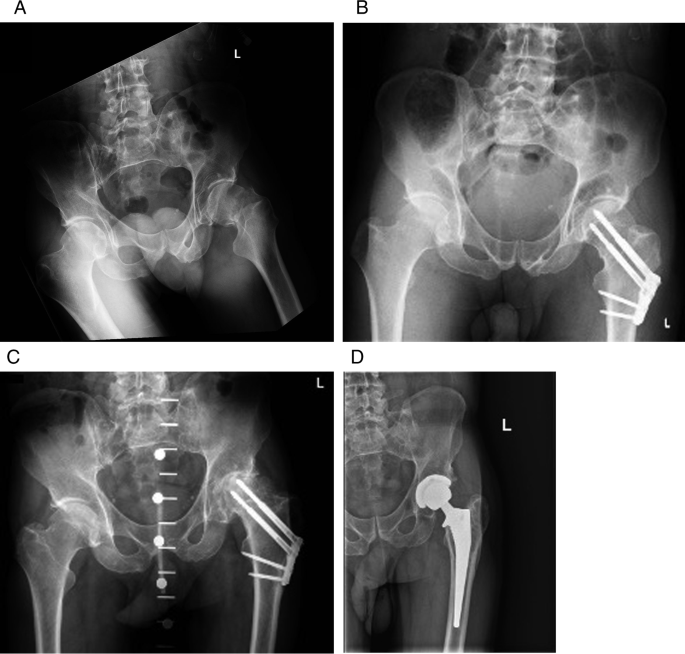 Risk assessment of femoral head AVN following reduction and fixation of ...